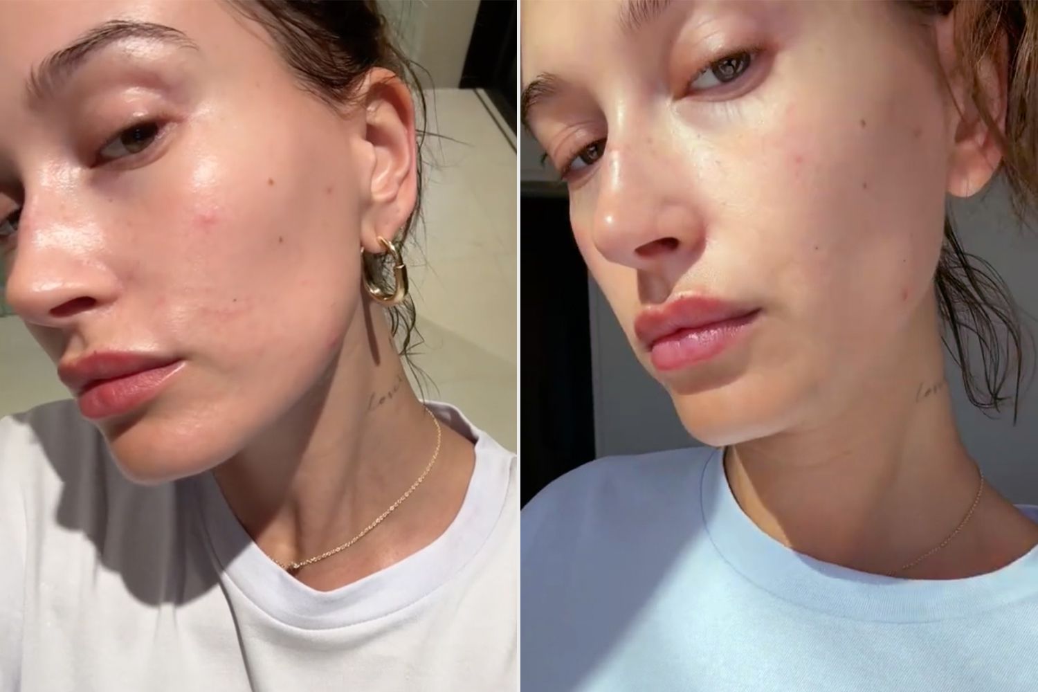 Hailey Bieber revela su lucha contra un trastorno cutáneo | Notigram