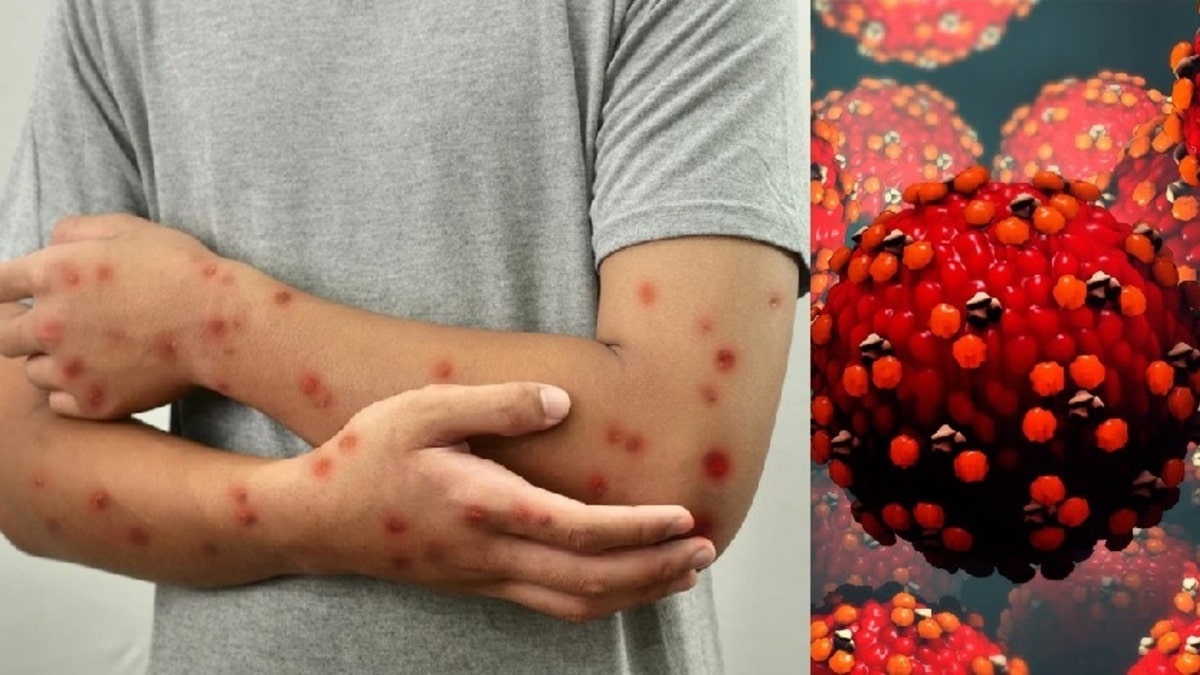 Aumento de casos de Sarampión en México: Siete confirmados en 2024 | Notigram